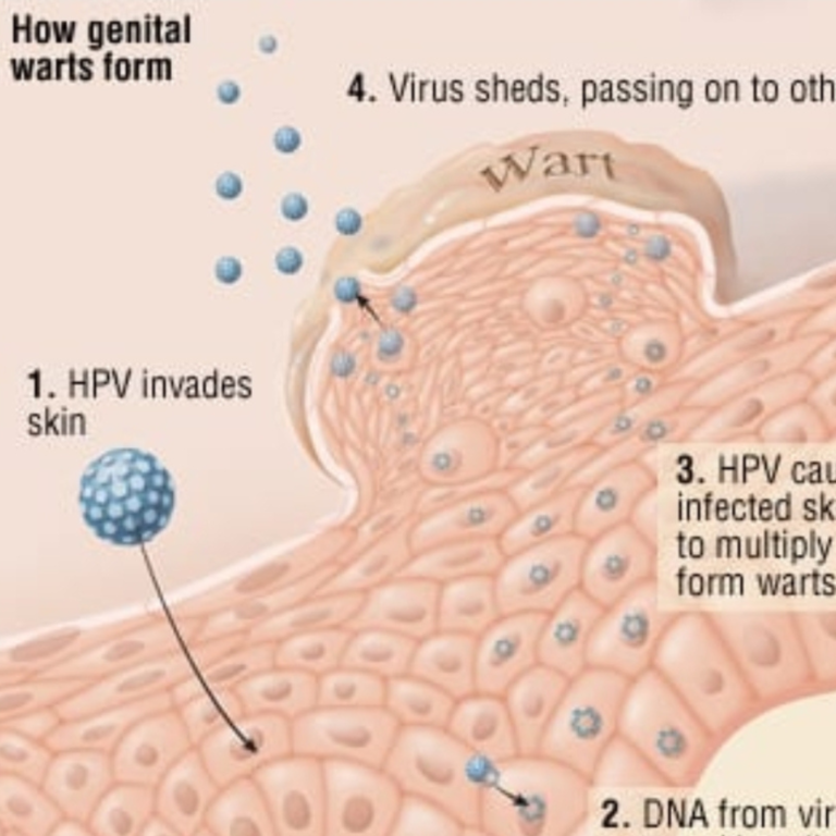 Anogenital Warts - Symptoms, Treatments & Prevention